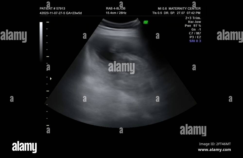 Echograph Stock Videos & Footage - HD and 4K Video Clips - Alamy