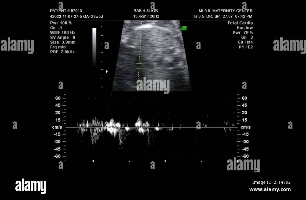 Ultrasound cardiogram Stock Videos & Footage - HD and 4K Video Clips ...