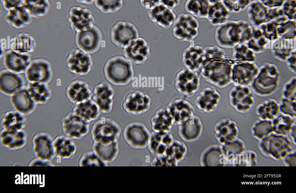 Blood under a microscope. Conditionally pathogenic bacteria in blood ...