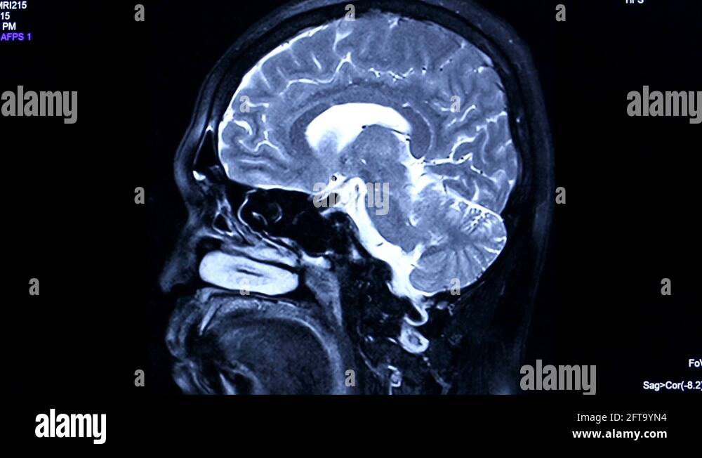 MRI brain scan, Side view Stock Video Footage - Alamy