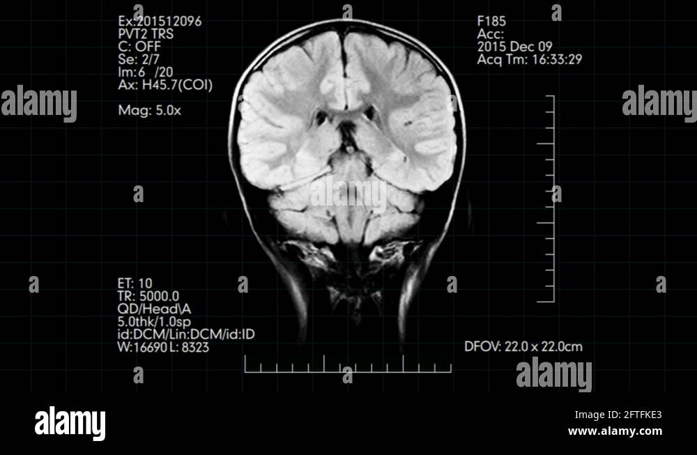 Black and white MRI brain scan animation Stock Video Footage - Alamy