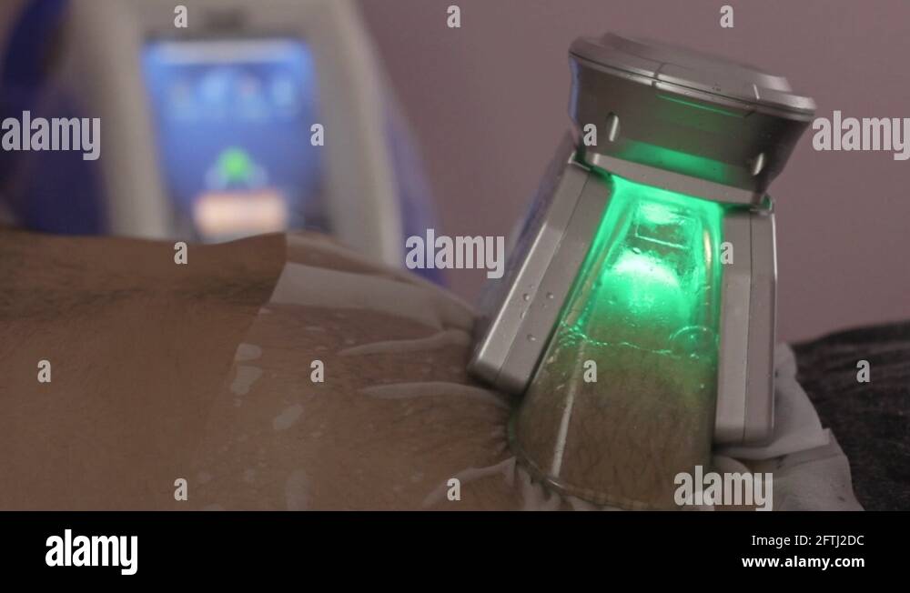 Cryolipolysis CoolSculpting Cold Lipo Procedure On A Male Patient Belly ...