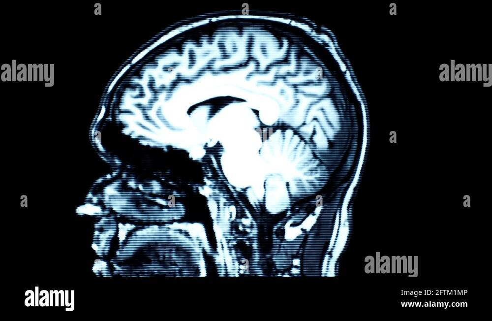 MRI of human Brain - particles form Stock Video Footage - Alamy