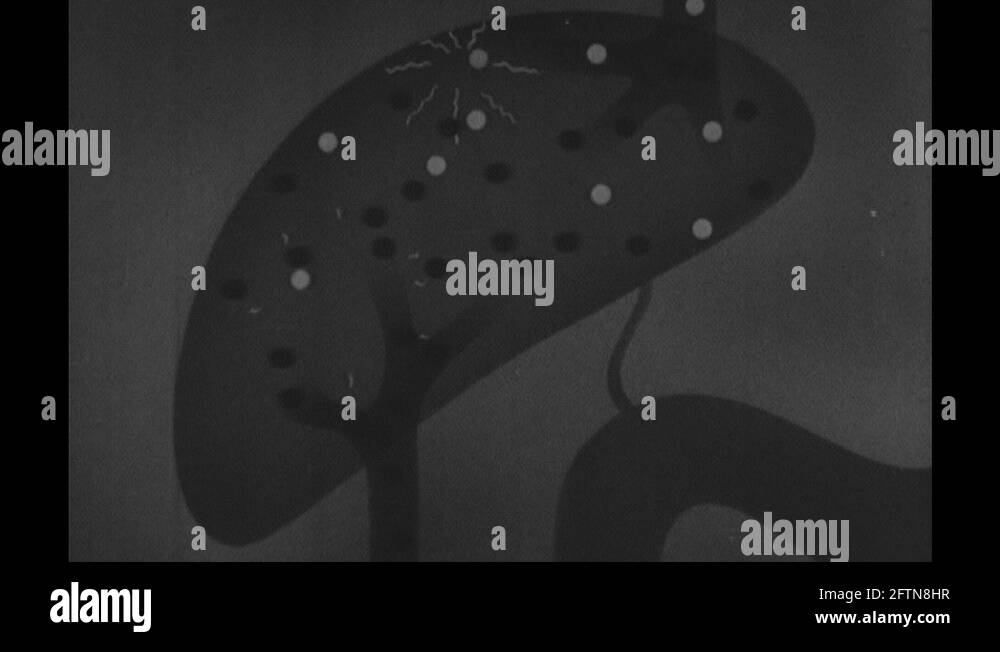 1960s: diagram of a liver with black particles and white particles ...