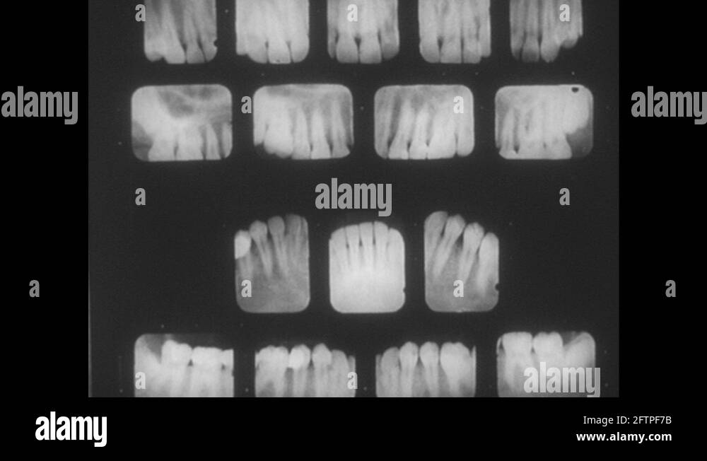 UNITED STATES, 1944: X-rays of teeth are shown and patients are worked ...