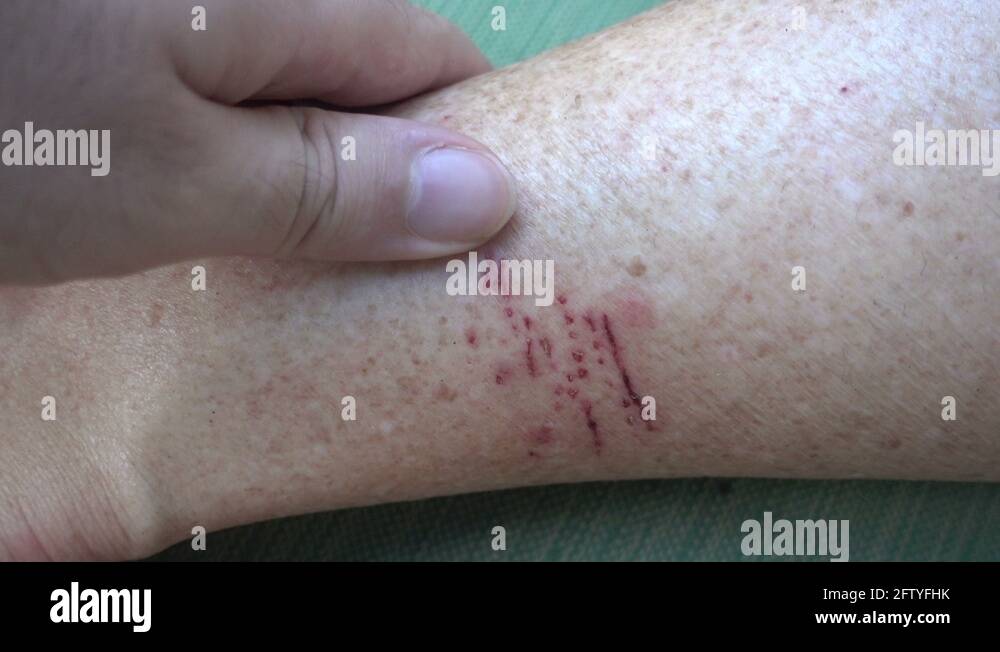 Scab scar Stock Videos & Footage - HD and 4K Video Clips - Alamy