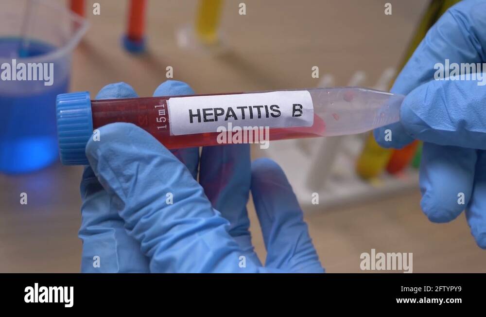 Hepatitis b test Stock Videos & Footage - HD and 4K Video Clips - Alamy