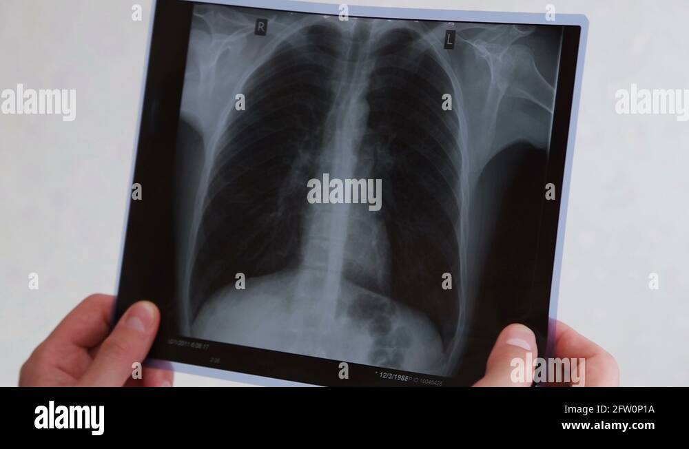Chest x ray bronchitis Stock Videos & Footage - HD and 4K Video Clips ...