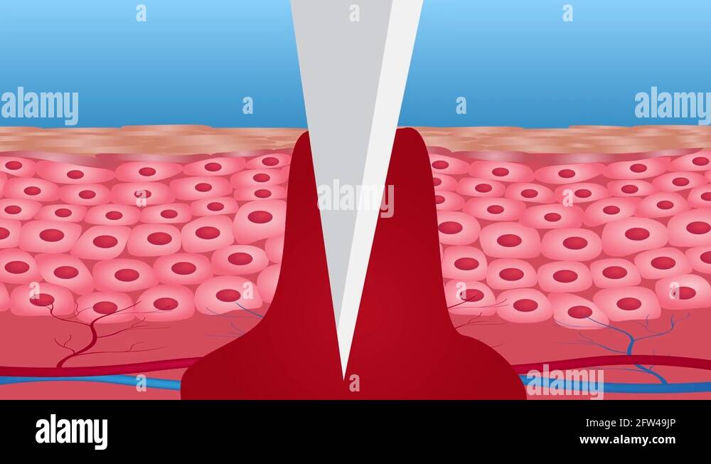 Bleeding into the skin Stock Videos & Footage - HD and 4K Video Clips ...