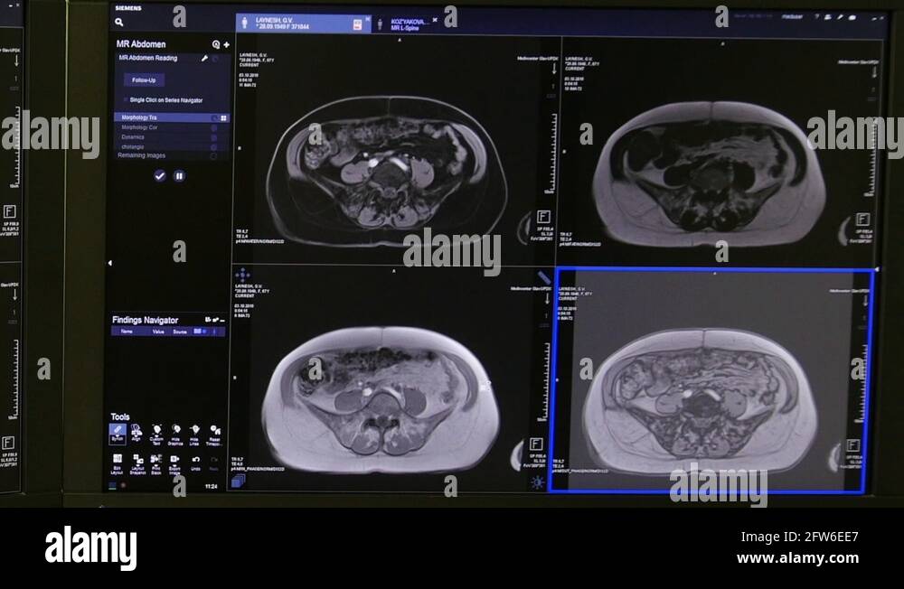 Cat scan mri tomography Stock Videos & Footage - HD and 4K Video Clips ...