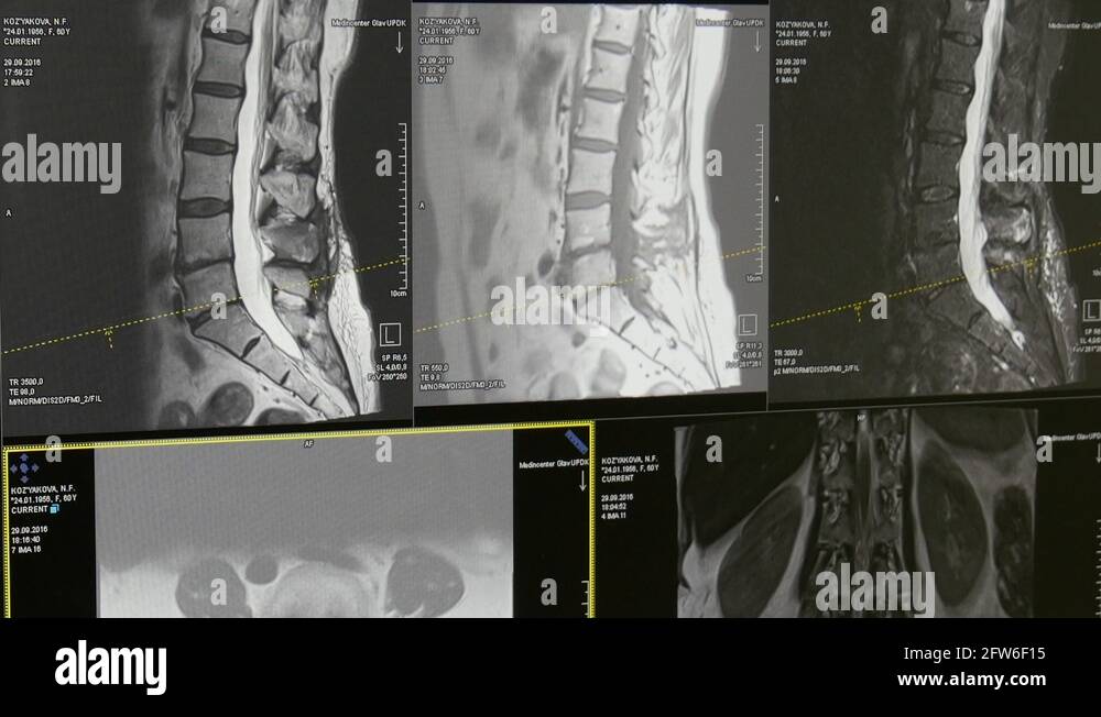 Spinal cord and spinal column tomography on MRI scan Stock Video ...