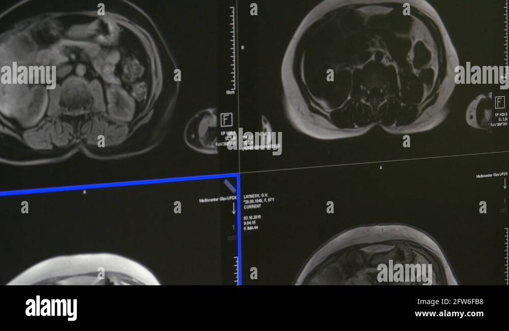 Brain tomography on MRI scan Professional Medical Equipment Stock Video ...