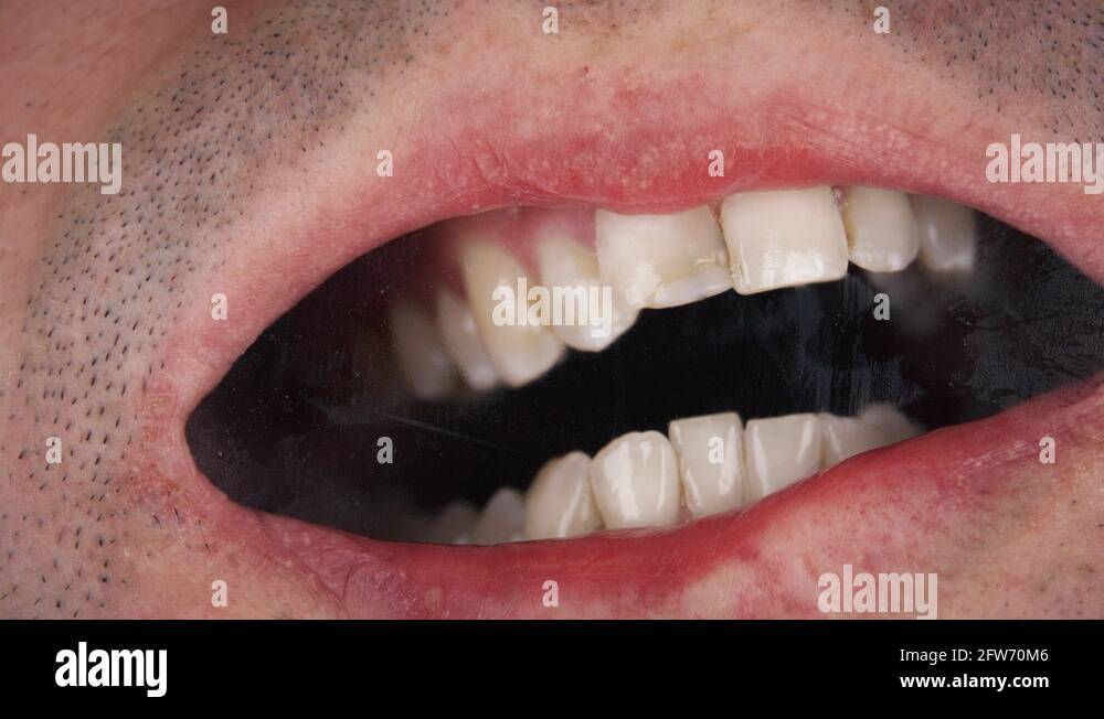Full set of teeth Stock Videos & Footage - HD and 4K Video Clips - Alamy