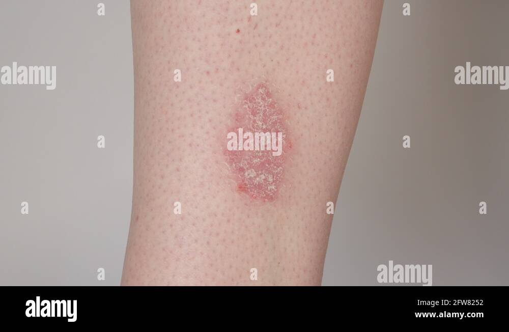 CLOSE UP: Flaky skin on unrecognizable psoriasis patient slowly peeling ...