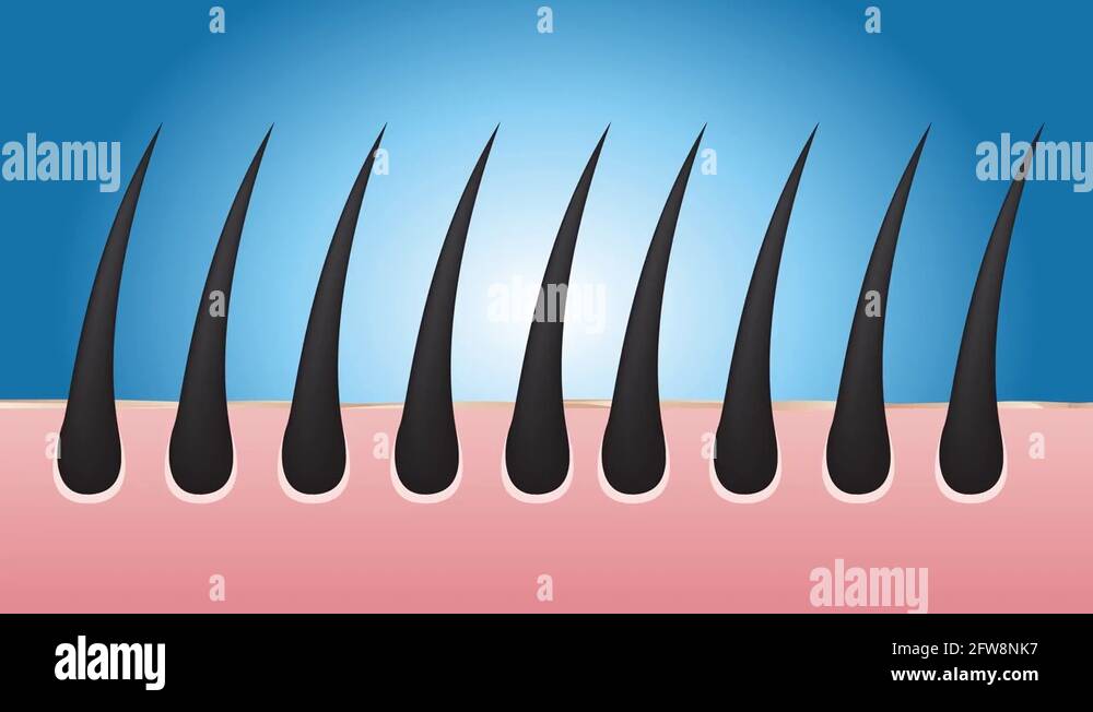 Dandruff stages vector , closeup on skin and dandruff ( black hair ...