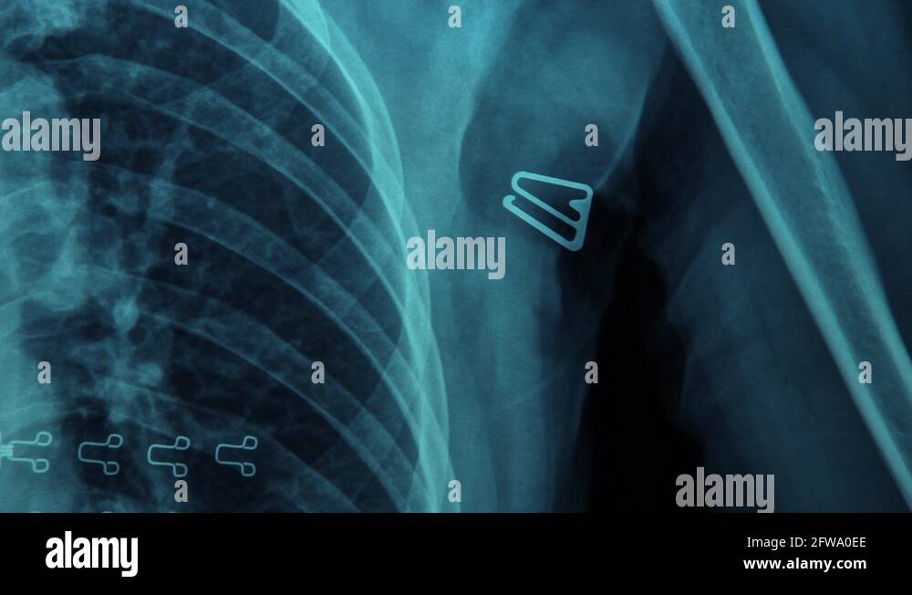 Broken collar bone Stock Videos & Footage - HD and 4K Video Clips - Alamy