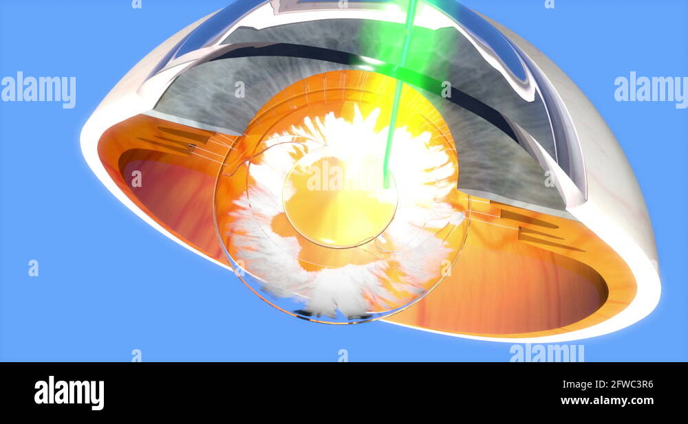 Intraocular lens iol Stock Videos & Footage - HD and 4K Video Clips - Alamy