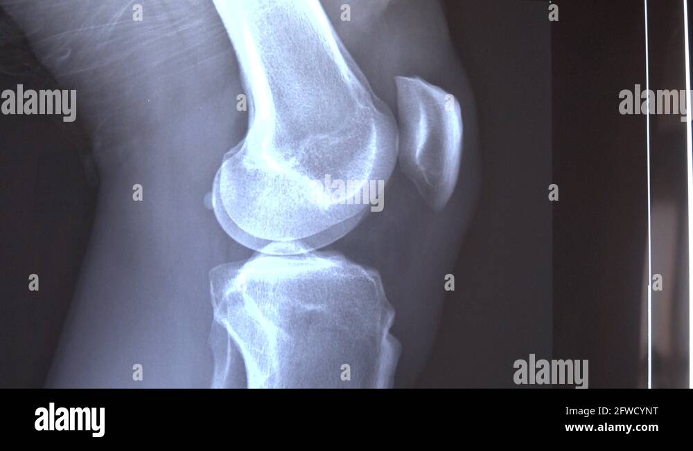 X ray of knee joint, tibia, and fibula leg bones Stock Video Footage ...