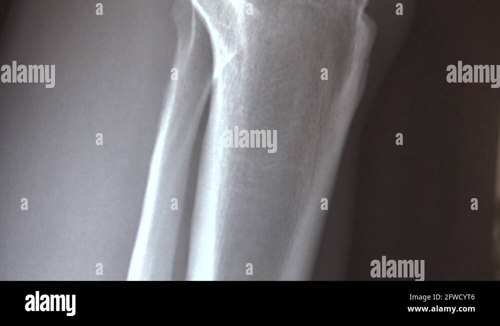 X ray of knee joint anatomy with tibia and fibula leg bones CLOSE UP ...