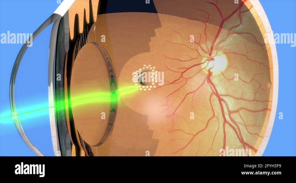 Laser photocoagulation around retinal tear, 3d render, 4K Stock Video ...