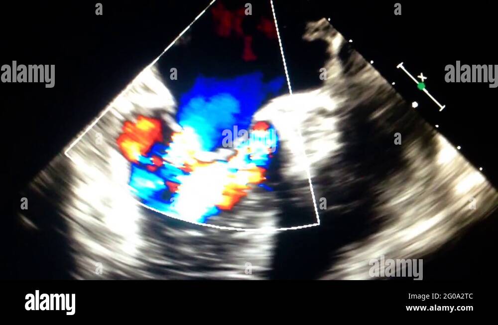 Echocardiography (ultrasound examination of the heart Stock Video ...