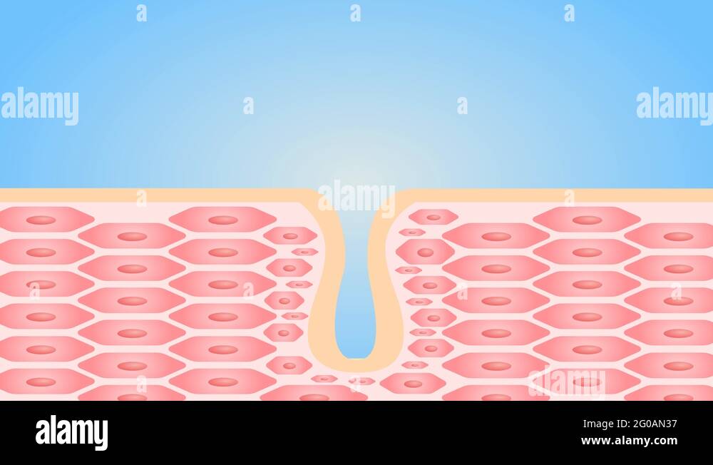 Acne and Pimples, stages of development, graphic Stock Video Footage ...