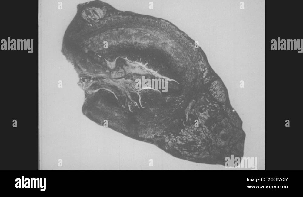 1930s: Cross-Section Of Ruptured Appendix. Arrow Moves Across Appendix ...