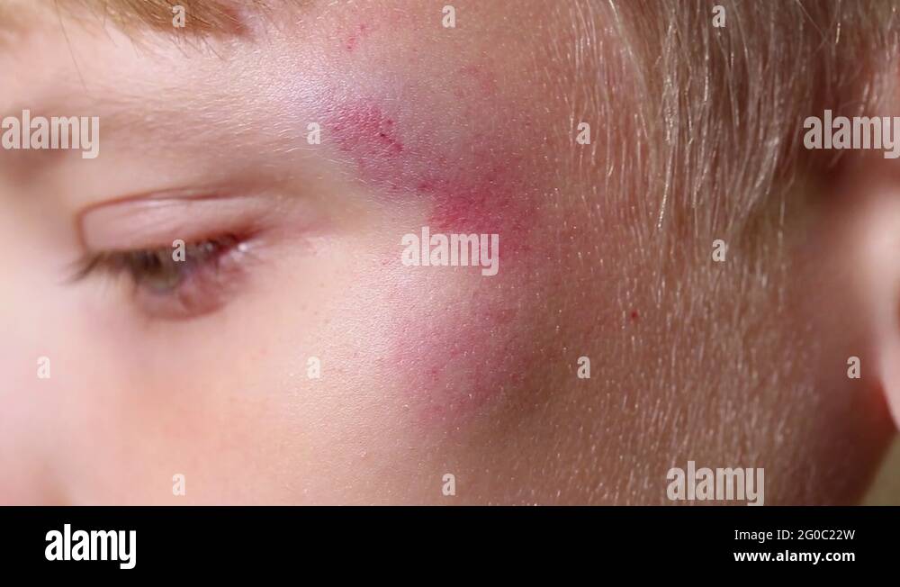 Red bruise Stock Videos & Footage - HD and 4K Video Clips - Alamy