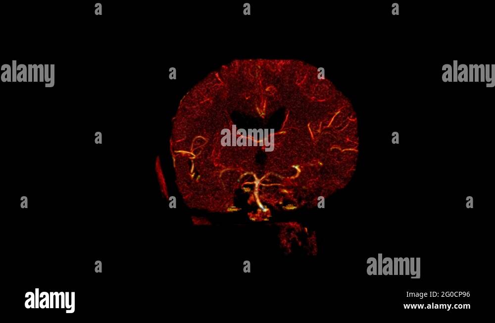 3d heart ct scan anatomy ventricle Stock Videos & Footage - HD and 4K ...