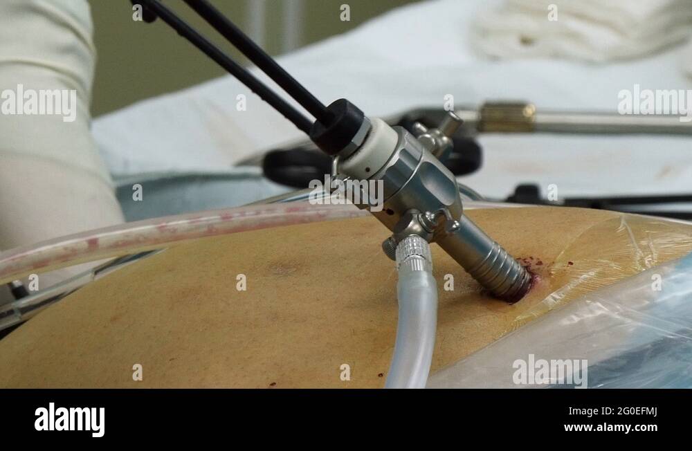 Abdominal laparoscopy in operating room close-up Stock Video Footage ...
