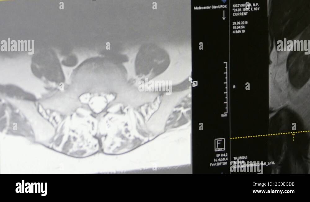 Spinal cord injury mri Stock Videos & Footage - HD and 4K Video Clips ...