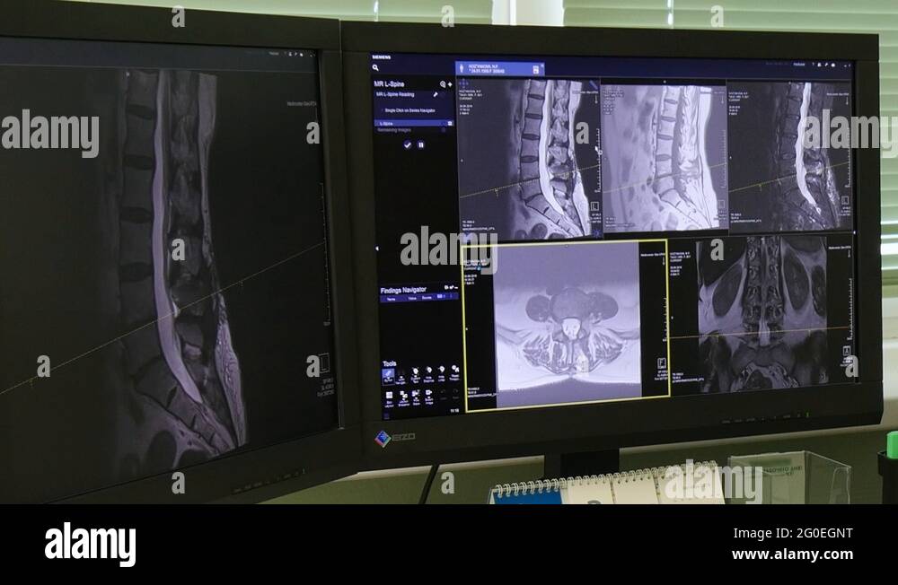 Doctor makes spinal cord and spinal column tomography on MRI scan Stock ...
