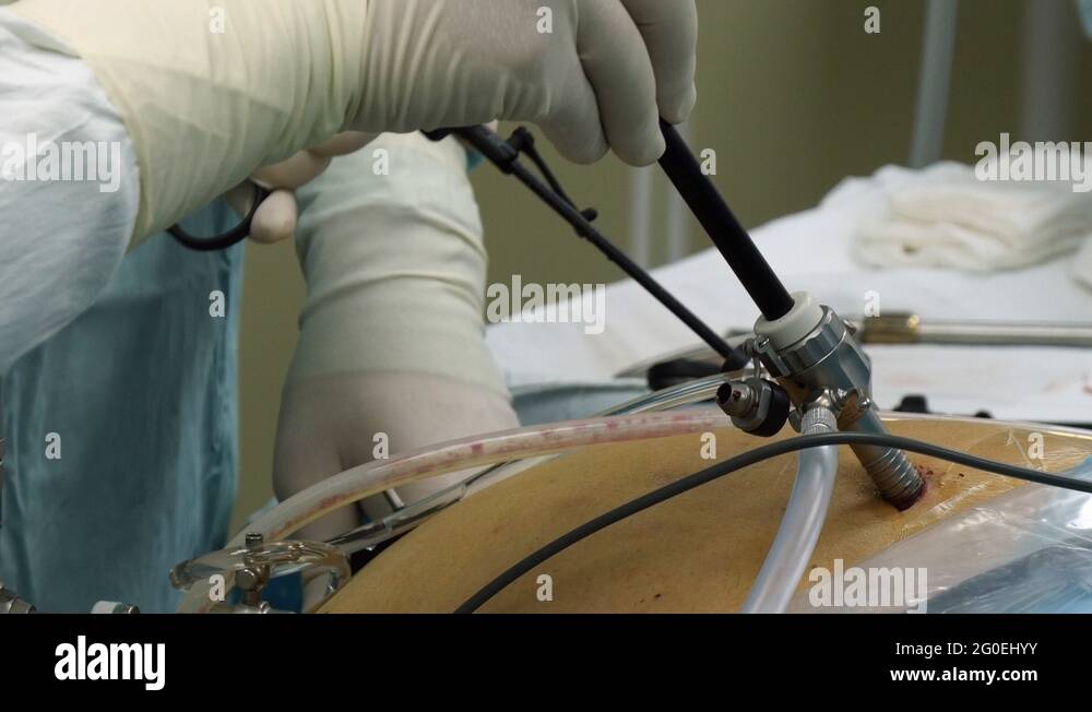 Abdominal laparoscopy in operating room close-up Stock Video Footage ...