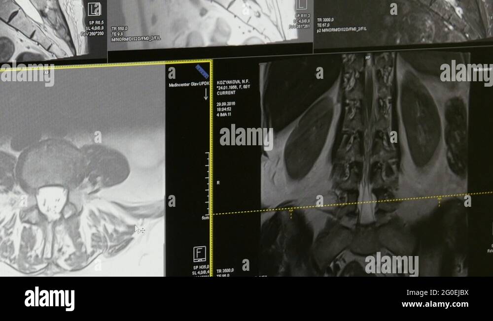 Spinal cord and spinal column tomography on MRI scan Stock Video ...