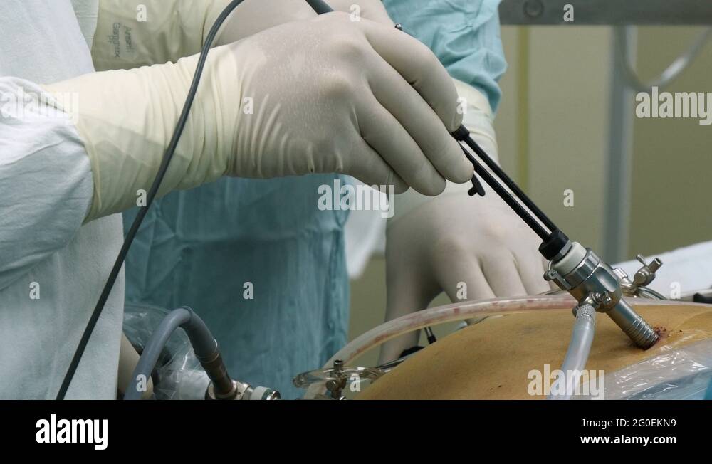 Abdominal laparoscopy in operating room close-up Stock Video Footage ...