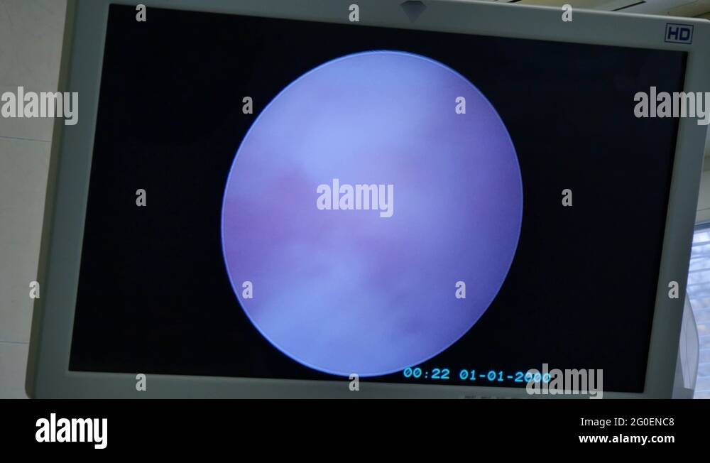 Female neck of uterus womb cervix uteri on monitor gynecological ...