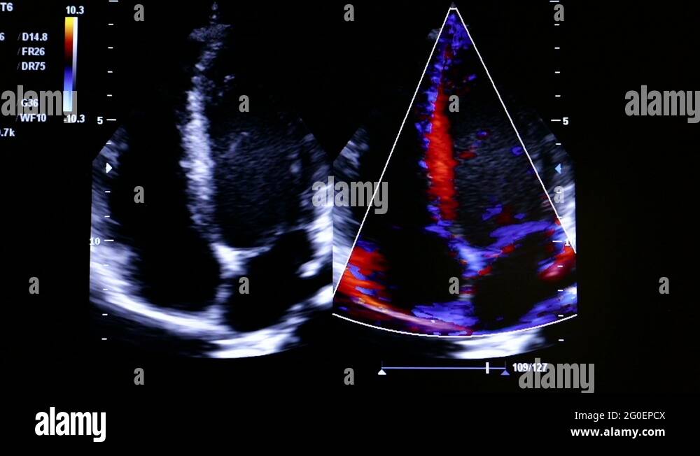 Heart ultrasound monitor Stock Videos & Footage - HD and 4K Video Clips ...