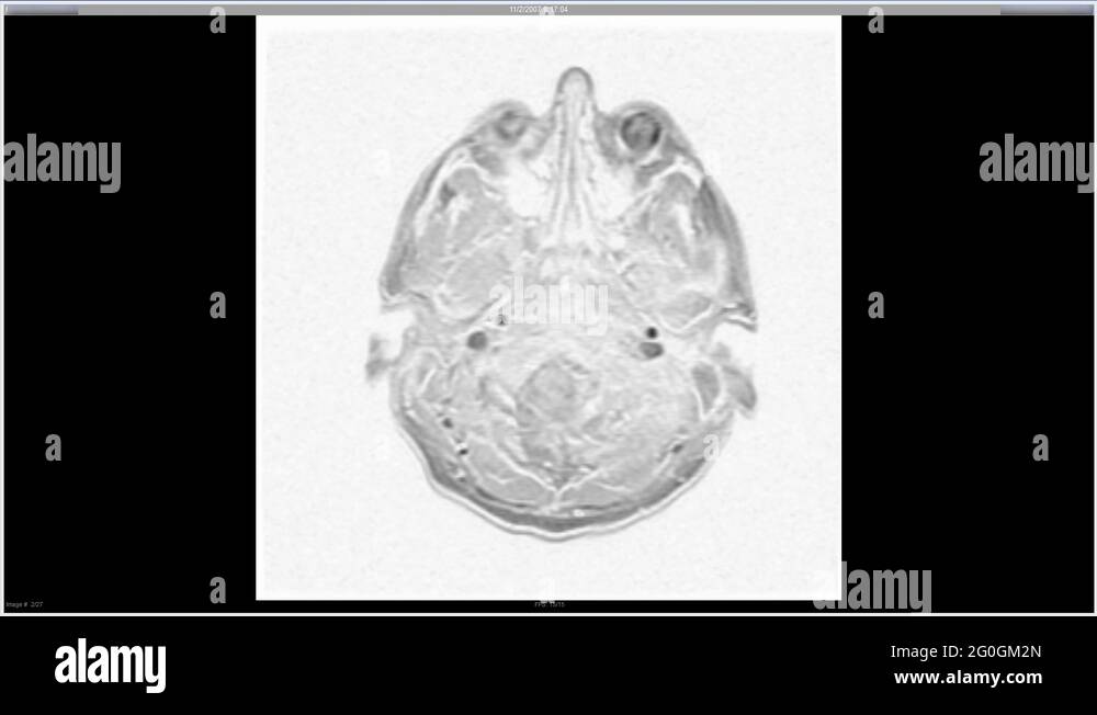 Brain mri Stock Videos & Footage - HD and 4K Video Clips - Alamy