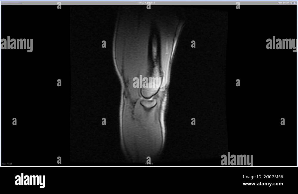 Tendon tear Stock Videos & Footage - HD and 4K Video Clips - Alamy