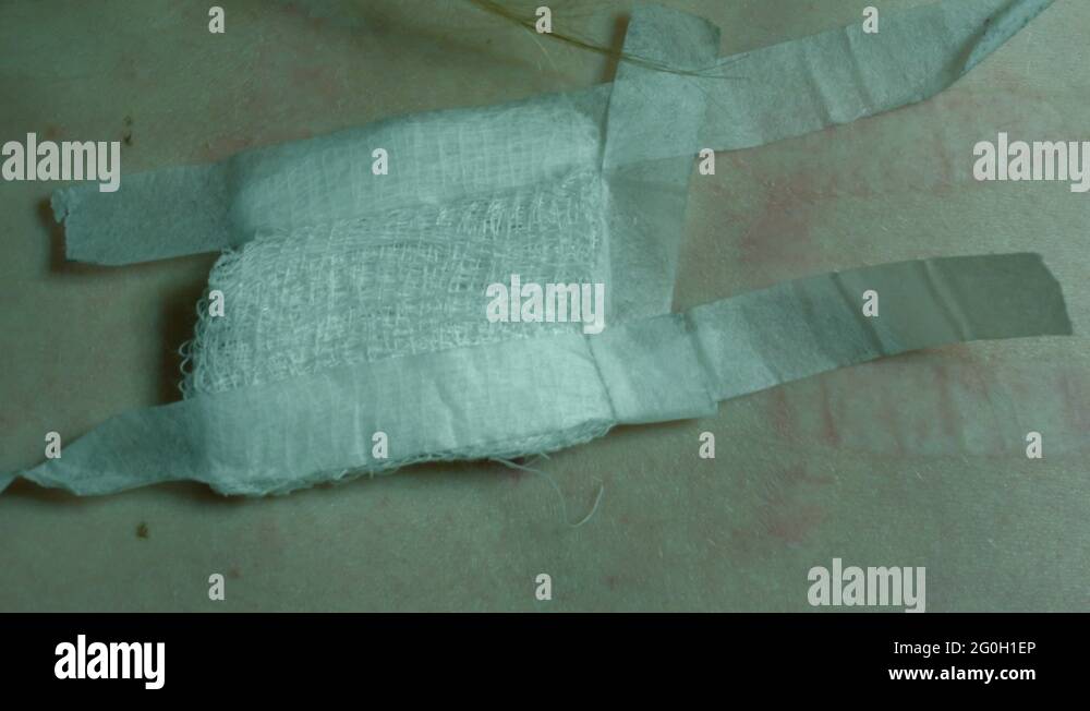 Surgery scar Stock Videos & Footage - HD and 4K Video Clips - Alamy