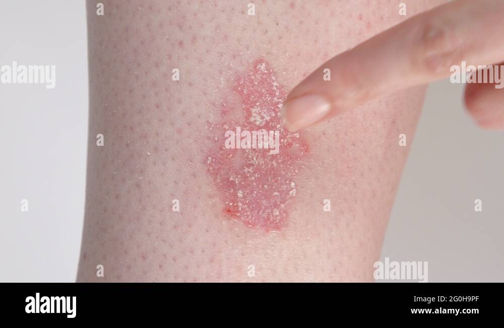Skin plaques Stock Videos & Footage - HD and 4K Video Clips - Alamy