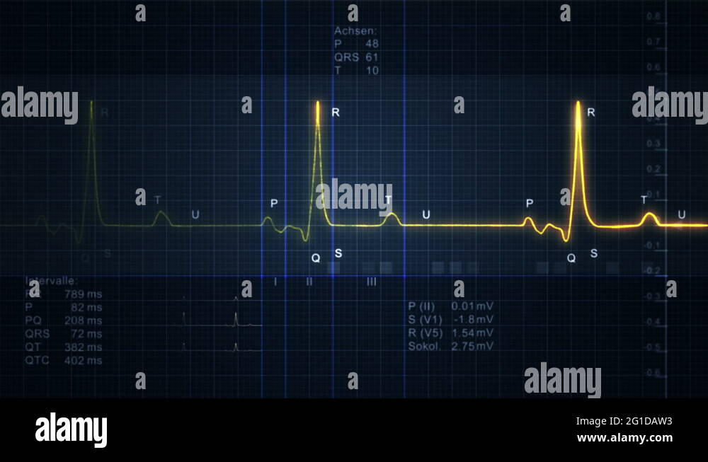Electrocardiogram trace Stock Videos & Footage - HD and 4K Video Clips ...