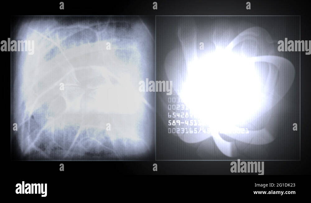 Röntgen hand x ray Stock Videos & Footage - HD and 4K Video Clips - Alamy