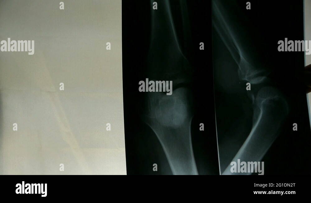 Bone dislocation xray Stock Videos & Footage - HD and 4K Video Clips ...