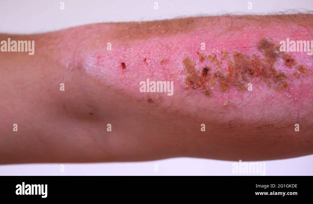 Burn mark on hand Stock Videos & Footage - HD and 4K Video Clips - Alamy