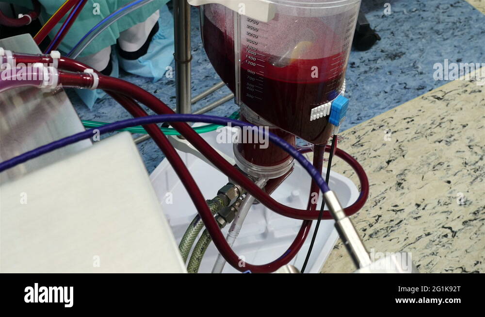 Cardiac bypass machine Stock Videos & Footage - HD and 4K Video Clips ...