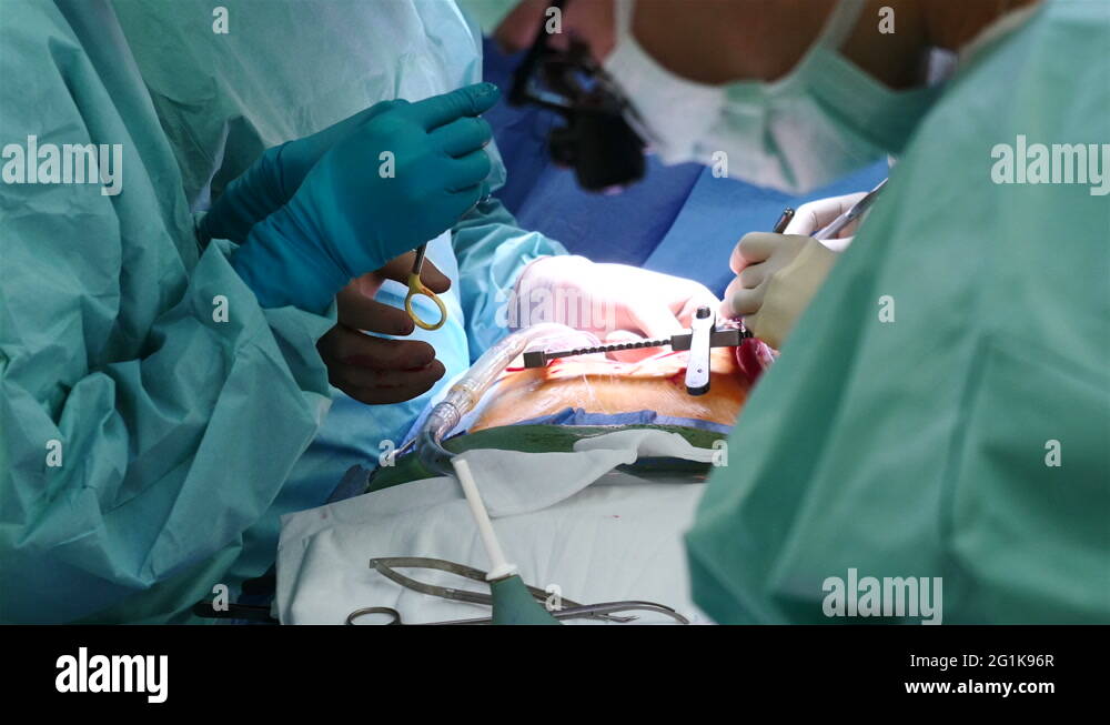 Cardiac surgeons performing a open heart surgery, Full HD Stock Video ...