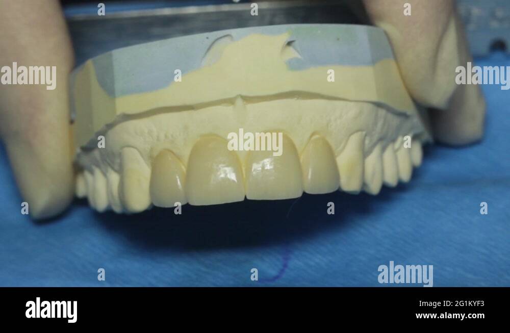 Dental Cast Jaws, Dentures, Dental Veneers Stock Video Footage - Alamy