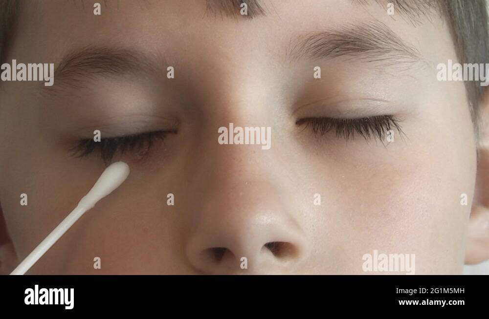 Meibomian abscess Stock Videos & Footage - HD and 4K Video Clips - Alamy