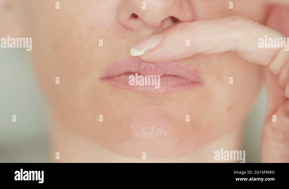 girl touching sores on the lips. herpes. lip treatment Stock Video ...